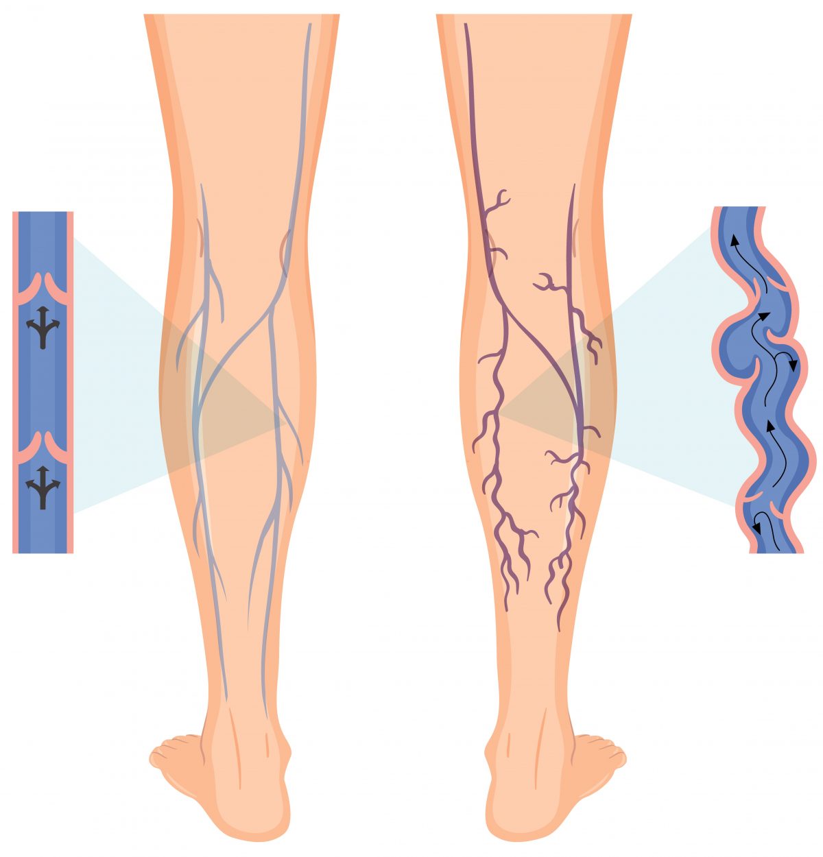 Flebología: ¿De qué se ocupa un flebólogo? - Genea